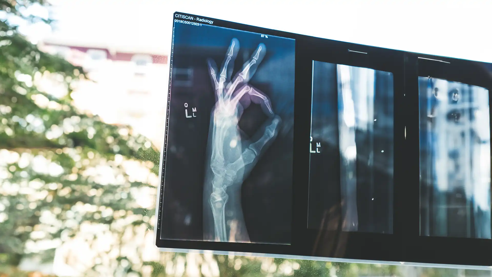 Bone Health and Eating Disorders - Harmony Nutrition